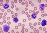 Normocytic Normochromic Anemia Causes and Management | New Health Guide